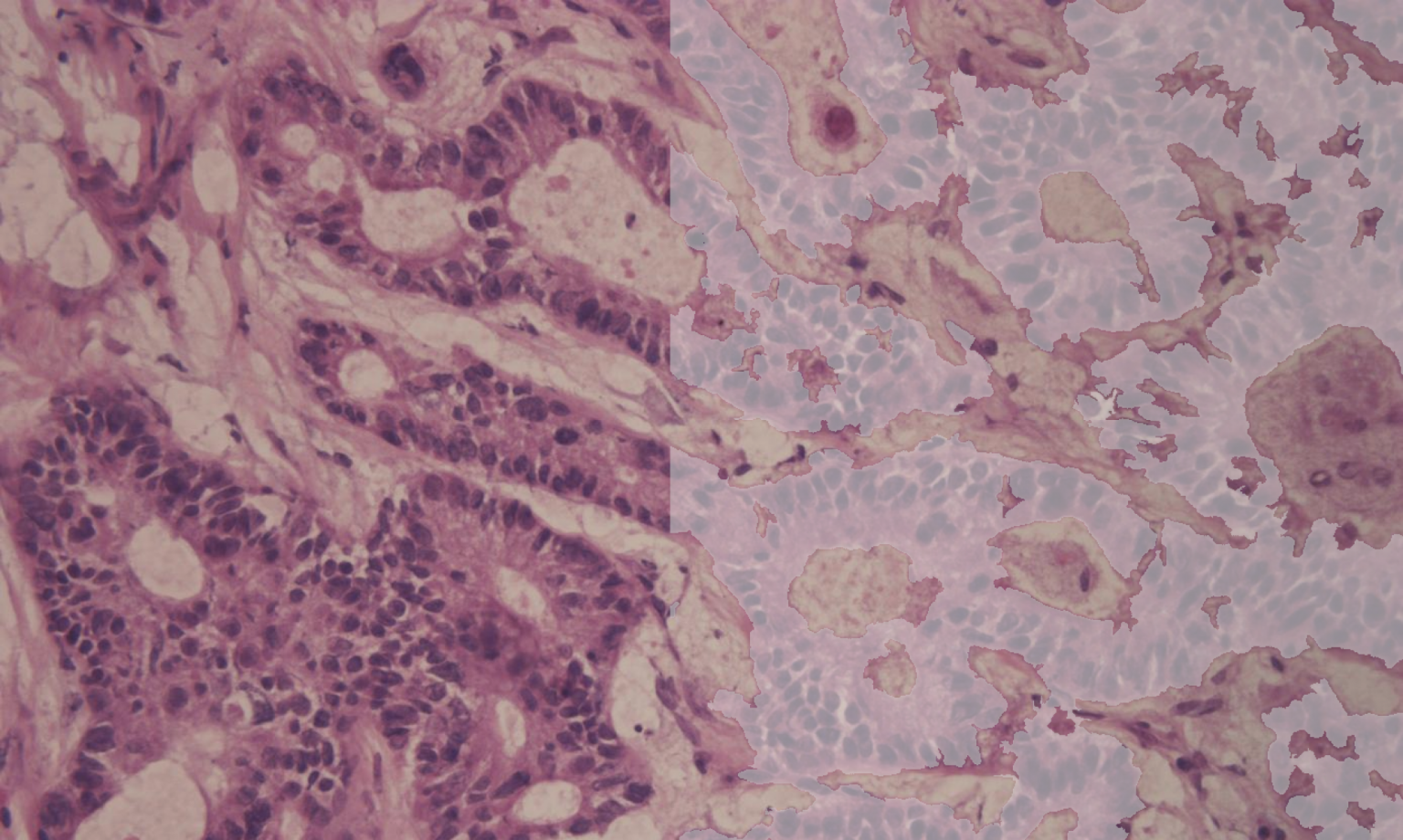 CoCaHis Dataset – Colon Cancer Histopathological Dataset